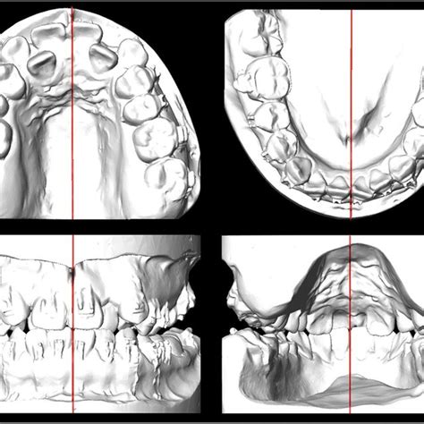 Pdf Surgical Occlusion Setup In Correction Of Skeletal Class Iii Deformity Using Surgery First