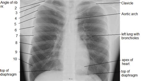 胸部x光檢查 Chest X Ray ★ 優活 健康網 ★ Living Well Website