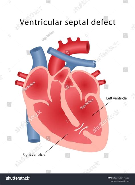 Ventricular Septal Defect Heart Defect Medical Stock Vector Royalty Free 2599476533 Shutterstock