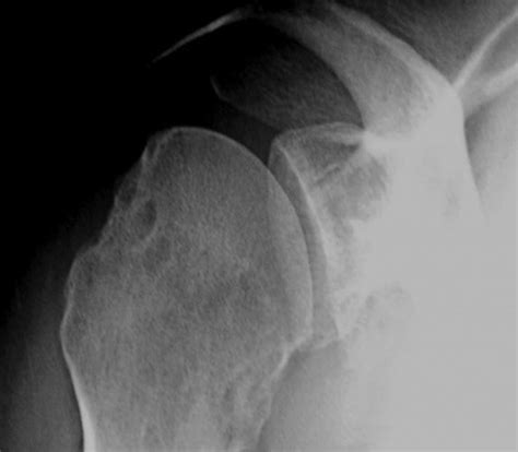 Apical Oblique View A Radiographic Cassette Is Placed Flat Against The