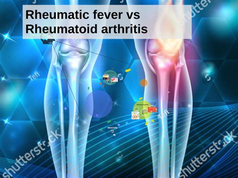 Rheumatic Fever Vs Rheumatoid Arthritis By Abeer Ahmed On Prezi