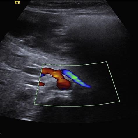 Transverse Color Doppler Ultrasound Image Shows A Widely Patent Celiac