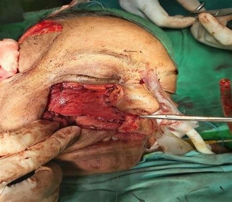Clinical Picture Showing The Surgical Procedure Of Partial Maxillectomy Download Scientific