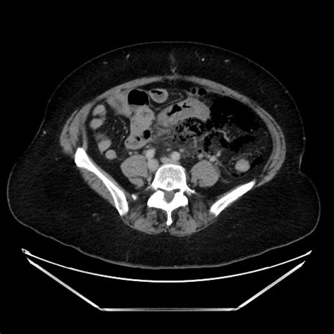 Fileperforated Sigmoid Diverticulitis With Abscess