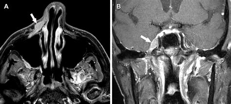 Skin Malignancies Imaging Review With Radiologic Histopathologic Correlation Radiographics