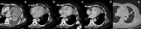 Chest Computed Tomography Ct Of The Patient A Chest Ct Showed An