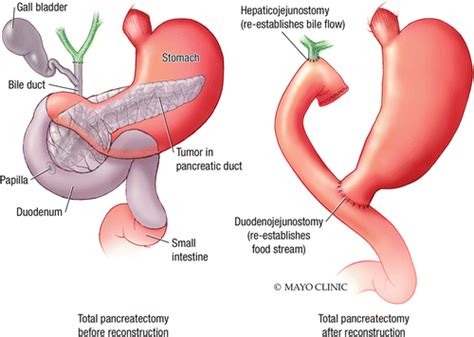 Distal Pancreatectomy