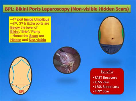 Nikitha Hospital Visakhapatnam Laparoscopy Keyhole Surgery