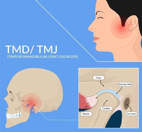 Botox For Tmj Relief Plantation Med Spa