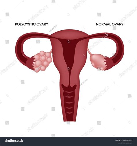 Uterus Polycystic Ovary Female Reproductive System Stock Vector Royalty Free 2416813857