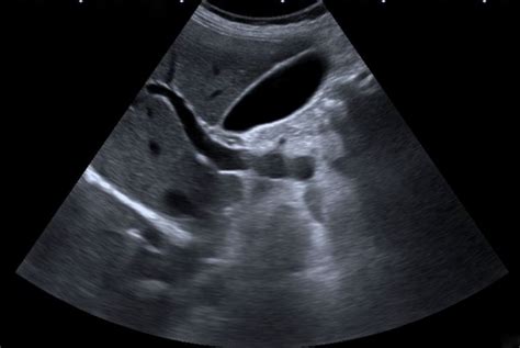 What Does A Gallbladder Ultrasound Diagnose