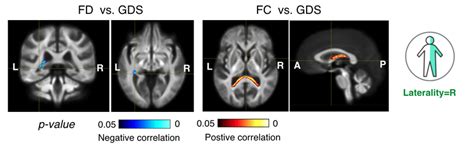 Correlation Between Fixel Based Metrics And Clinical Evaluations In