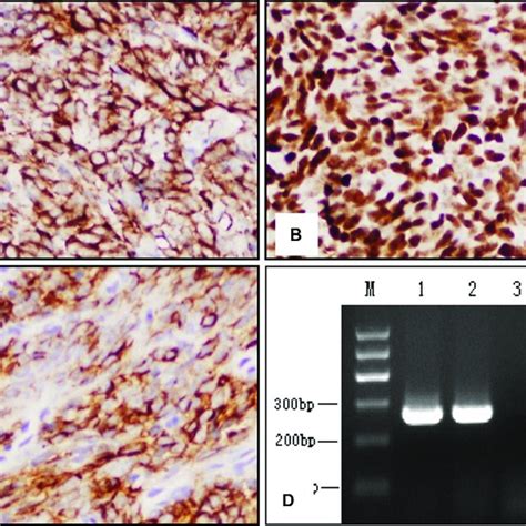 Primary Pulmonary Primitive Neuroectodermal Tumor In Previous Reports