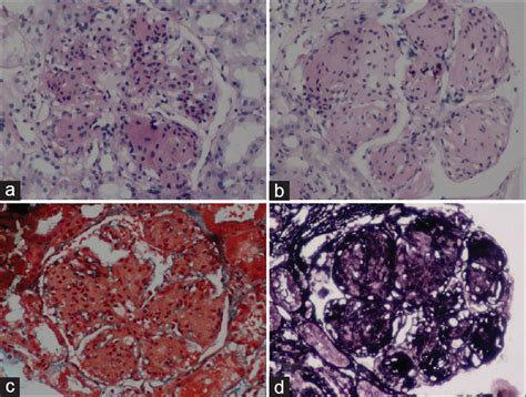 Idiopathic Nodular Glomerulosclerosis Report Of Two Cases And Review Of Literature Indian