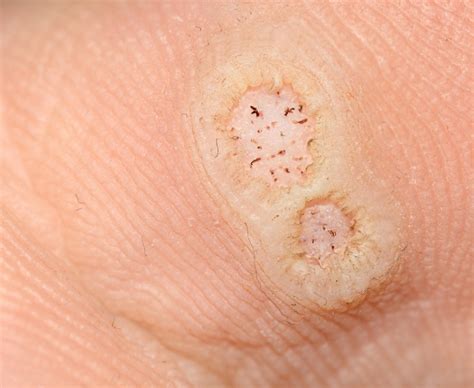 Genital Warts Causes Symptoms And Treatment Options