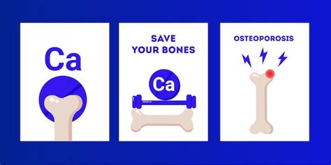 Premium Vector Osteoporosis Vector Medical Orthopaedic Posters With