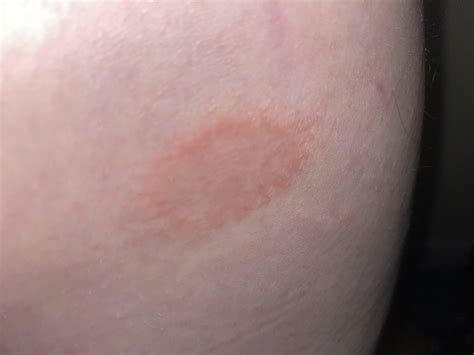 Is This Ring Worm R Askdoctorsmeeee