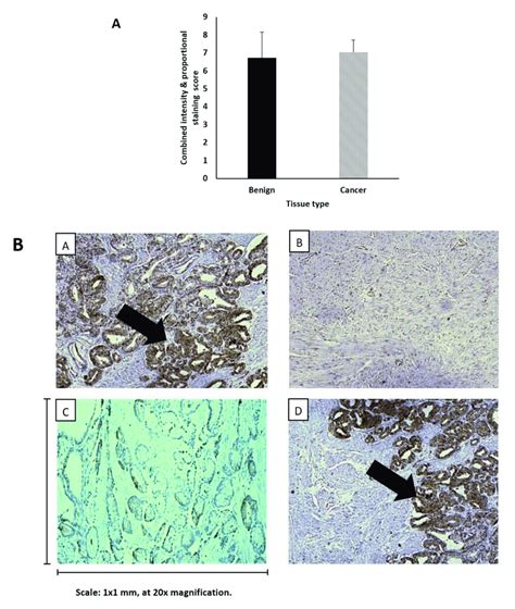 Ihc Staining Of Igf Ii Peptide In Benign And Malignant Prostate Tumour