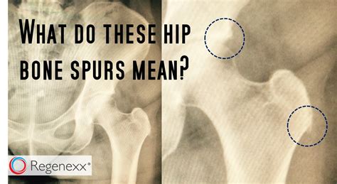 What Is A Spur On Hip At Danelle Perez Blog
