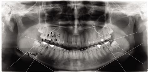 The Role Of Impacted Third Molar Angulation On The Anterior Crowding Apos Trends In Orthodontics