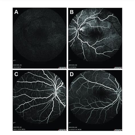 Fundus Fluorescein Angiography Ffa 6 Months After Balloon