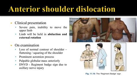 Shoulder Dislocation Types Clinical Features Pptx
