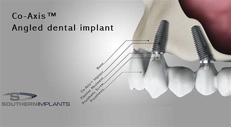 Co Axis Angled Dental Implant Toothnewsgr