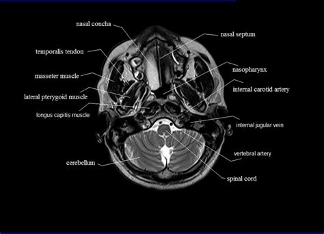 Buccinator Muscle Mri