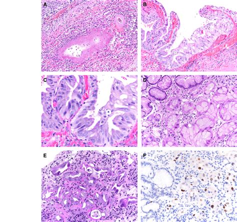 A The Gallbladder Specimen Shows Fibrinoid Necrosis Of Medium Sized Download Scientific