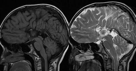 Neuroradiology Cases Corpus Callosal Agenesis
