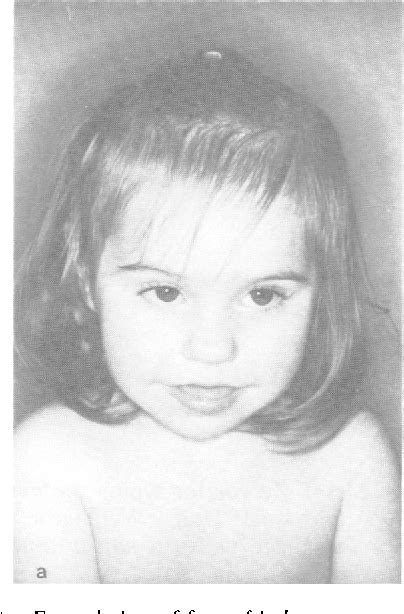 Figure 1 From Partial Monosomy 12pl3 113 3 Semantic Scholar