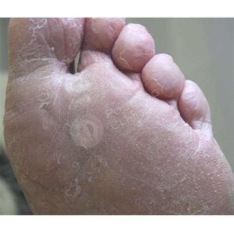 От чего появился зуд между пальцами ног Лечение грибка пальцев ног