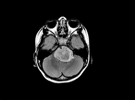 Глиобластома - Neuronovosti