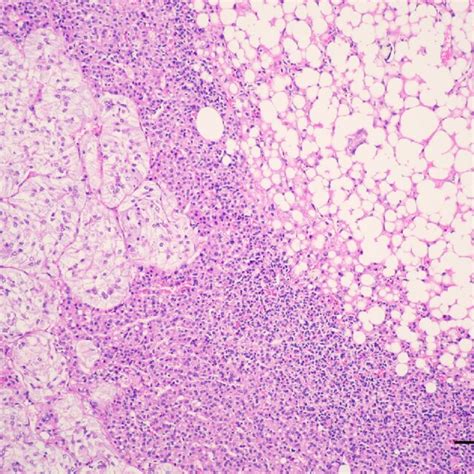 Expansile Nodular Lesion Embedded In The Adrenal Parenchyma Showing Download Scientific Diagram