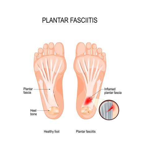 Plantar Fascia Stretch