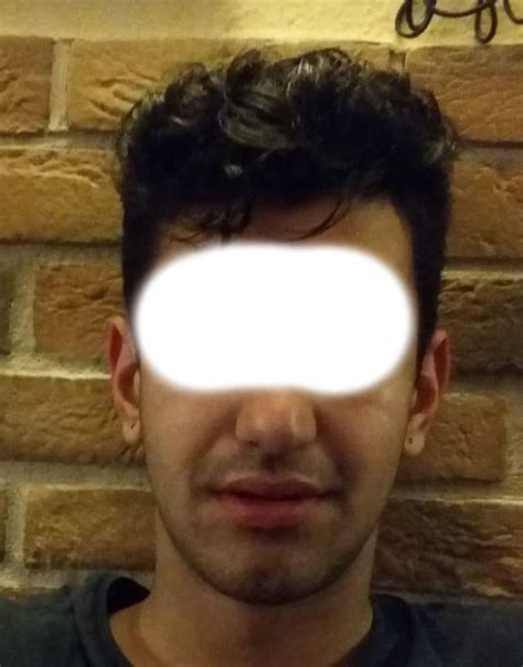 Before And After M Filler Cheek Chin Jaw Rplasticsurgery
