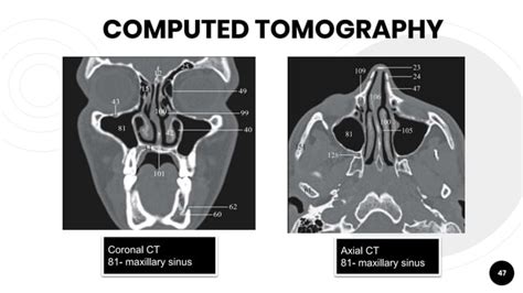 Maxillary Sinus Imaging Ppt