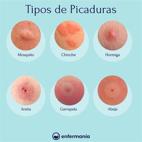 Enfermania 🔍 Tipos De Picaduras ¿sabrías Identificarlas Como