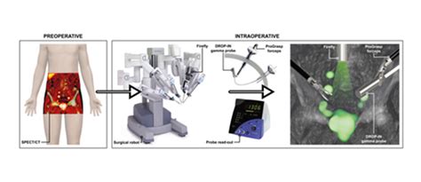 Flexible Lymph Node Detector Successful In Prostate Cancer Patients
