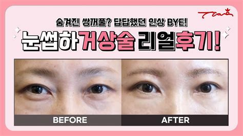인천성형외과 눈썹하거상술로 동안성형과 주름개선까지 Youtube