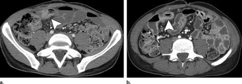 Ileocecal Crohn Disease In A 30 Year Old Woman The Patient Was Small