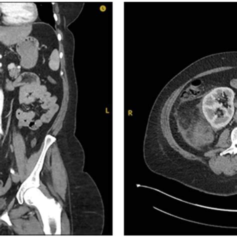 Interval Ct Imaging Showing Decrease In Size Of Lesion And Surrounding