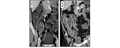 A 37 Years Old Male Patient With Ileocecal Junction And Terminal