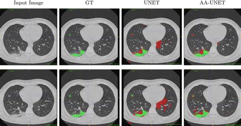 Visual Comparison Of Multi Class Lung Segmentation Results Where The Download Scientific