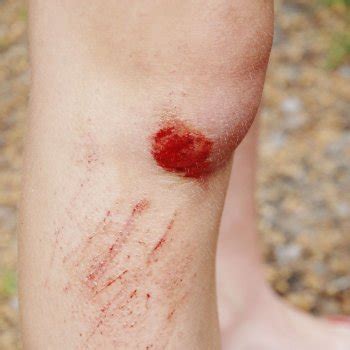 Celulitis en los niños Causas y tratamiento