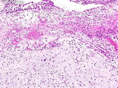 Sarcomatoid Urothelial Carcinoma