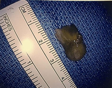 Gross Specimen Depicting The Resected Papillary Fibroelastoma Note The