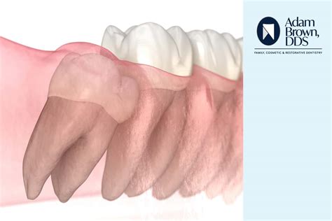 Do You Need Wisdom Teeth Removed Faqs At Adam Brown Dds