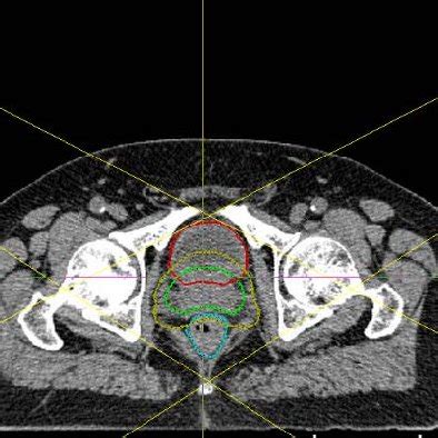 RTOG And Restrictive Dose Constraints Download Table