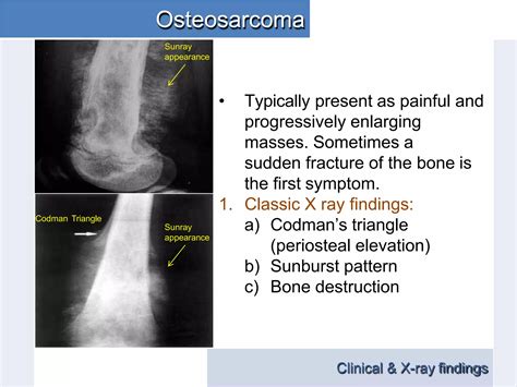 Pathology Of Bone Tumors Pptx Pathology Of Bone Tumors Pptx